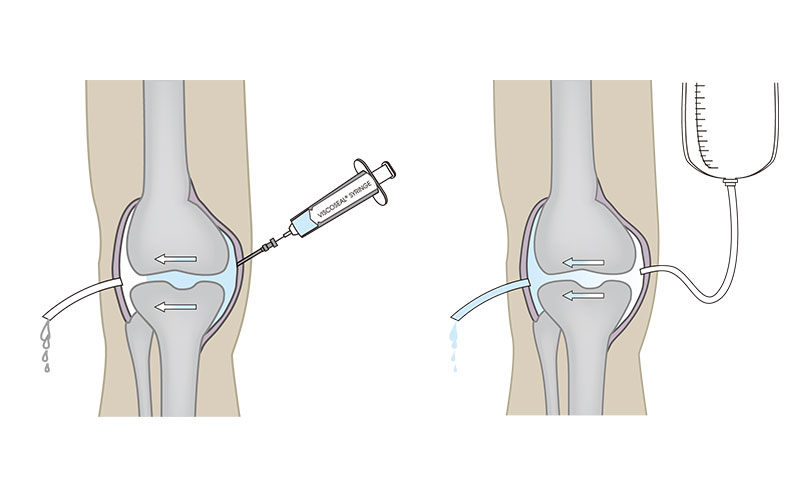 冠亞生技 - Viscoseal 維骨適膝關節腔滑液替代物